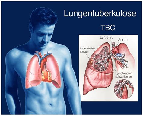 Tuberkulose Arzt Finden Infos