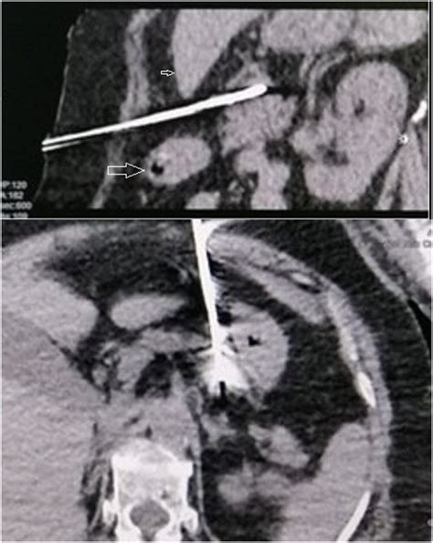 Ct Guided Percutaneous Microwave Ablation Using 17g Antenna Positioned