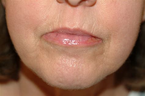 Cheilitis Actinic Actinic Cheilitis Solar Cheilitis Actinic