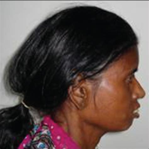 Progressive Systemic Sclerosis With Intraoral Manifestations A Case Report And Review PMC