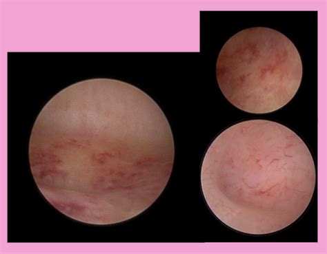 Diagnostic Hysteroscopy