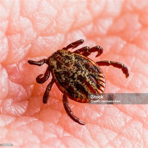 전염성 뇌염 진드기 곤충 피부에 뇌염 바이러스 또는 라임 보렐리오시스 질병 감염 된 피부경골 진드기 거미류 기생충 물린 진드기에