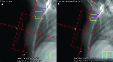 Coverage Of The Axillary Volumes With Standard A Or High B Tangent Download Scientific