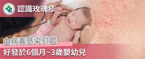 認識玫瑰疹