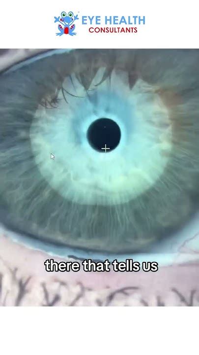 How Tear Film Testing Works Core Interferometry For Dry Eye Diagnosis