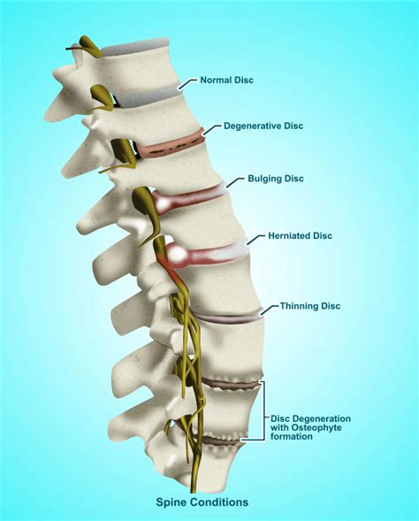 Self Spinal Decompression