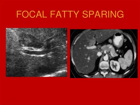 심한 지방간에서 종괴처럼 관찰되는 국소성 지방결여 Focal Fat Sparing
