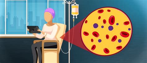 In Focus Minimal Residual Disease In Multiple Myeloma Oncology Central