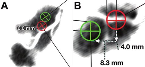 Measuring Avascular Zones On Ct Angiograms For Those Trajectories That