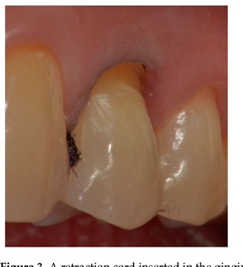 Figure 1 From Clinical Behavior Of The Gingival Margin Following