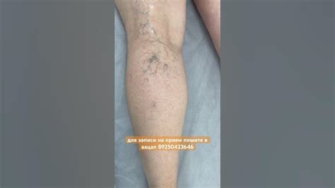 Сосудистая сетка на ногах Варикоза нет Повышенный вес Флеболог