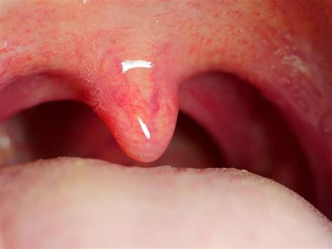 What Are The Causes Of Swollen Uvula Common Triggers Optinghealth