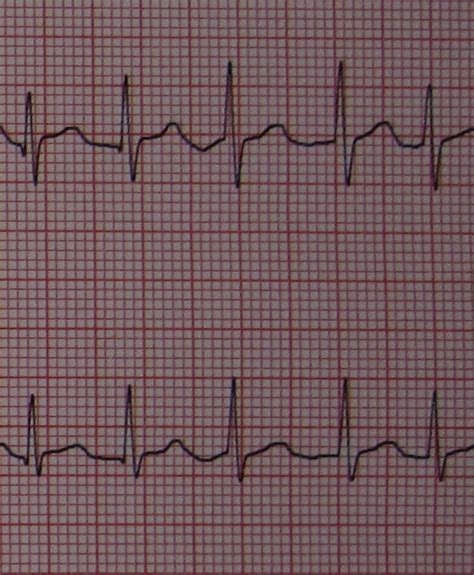 Fibrilacija Atrija Wikipedija