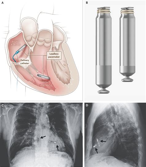 What Is A Shielded Pacemaker At Georgia Lai Blog