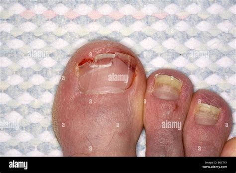 Torn Toe Nail Nail Ftempo