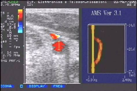 Visualization Obtainable On The Echograph With The Dual Image B Mode