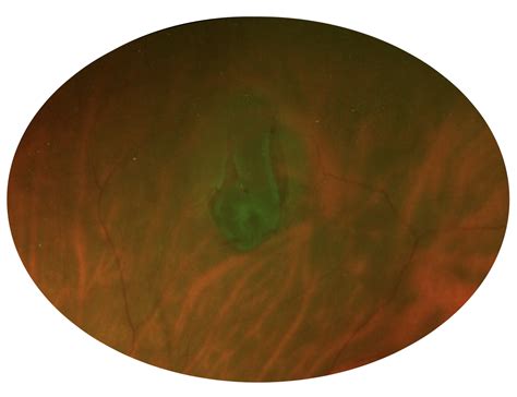 Retinal Tears Blue Coast Retina