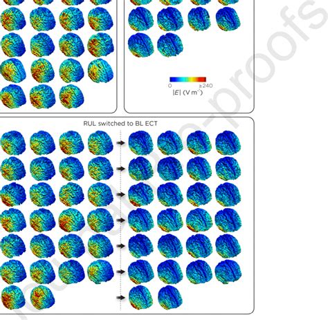 Distribution Of Modeled Electric Fields In Patients Treated With Right