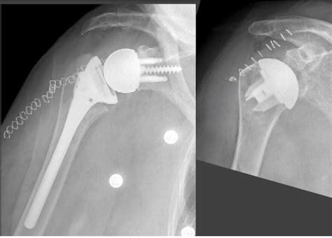 Anatomic Vs Reverse Total Shoulder What Evidence Is In The Literature Rick Matsen