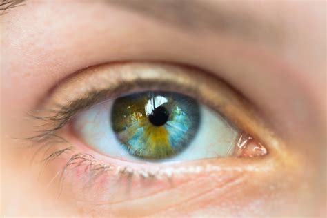 Itap Of My Eye Sectoral Heterochromia Ifttt2jay1id