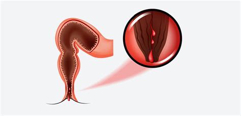 Laser Fissure Treatment Cost In Hyderabad Low Cost Fissure Surgery