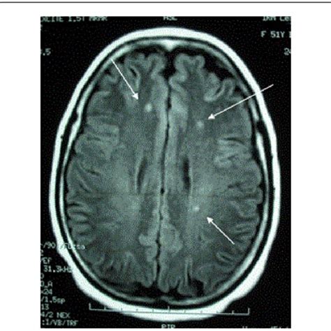 Periventricular White Matter Of Both Hemispheres With Moderate Global