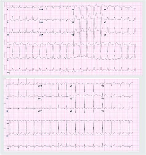 Ecg On Admission Of The Patient With Takotsubo Cardiomiopathy Showing