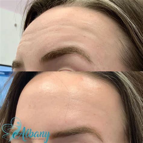 Botox Injections In Edmonton Albany Cosmetic And Laser Centre Medium
