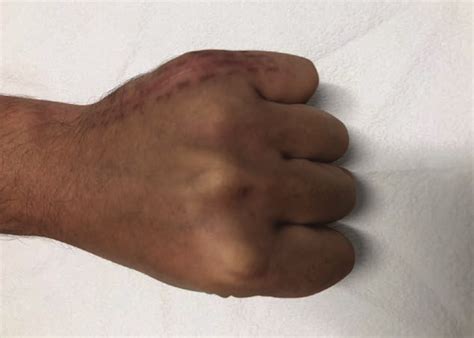 Patient Exhibiting Up To Degree Flexion At The MCp Joint Download Scientific Diagram