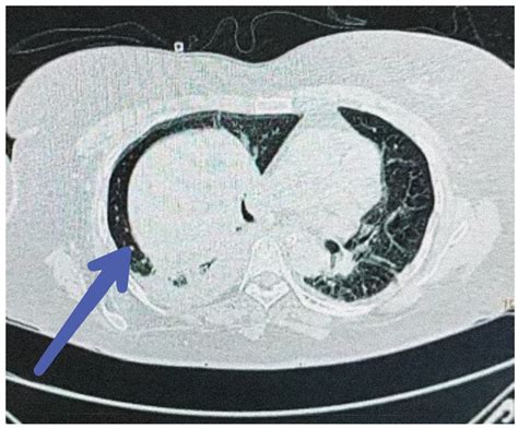 Possible Eventration Of Right Hemi Diaphragm Was Disclosed Download