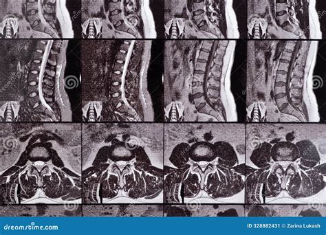 Mri Of A Patient With Intervertebral Disc Protrusion And
