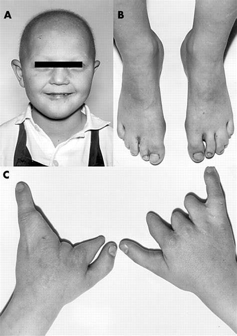Ectodermal Dysplasia Inheritance Patterns Ectodermal