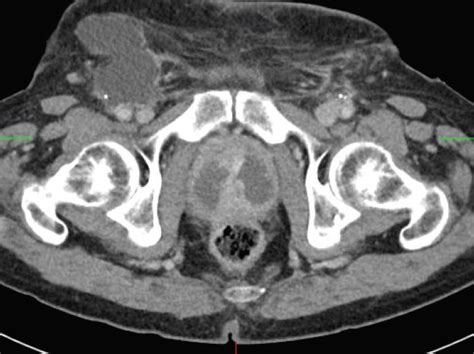 Prostatic Artery Chemoembolization The Next Frontier In Prostate Cancer Therapy Endovascular