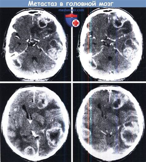 Нейрохирургия метастазов в головной мозг диагностика лечение