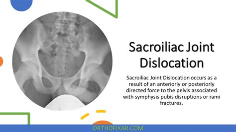 Sacroiliac Joint Dislocation Full Review Orthofixar 2025