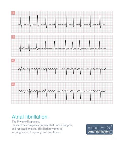 Atrial Fibrillation Photograph By Chongqing Tumi Technology Ltd Science Photo Library Fine Art