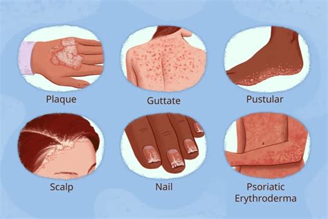 Psoriasis Symptoms Types Treatment Management