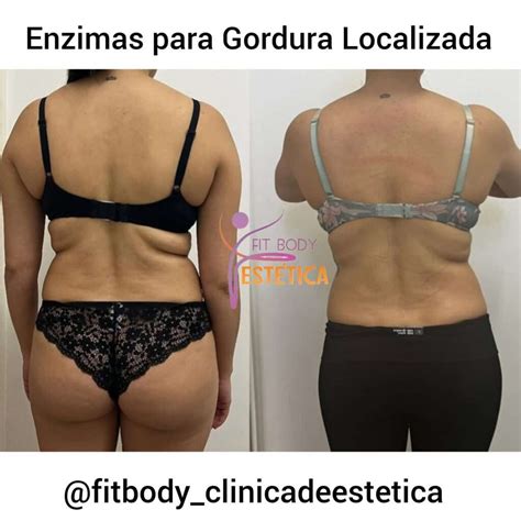 Enzimas Para Gordura Localizada Antes E Depois Clínica Fit Body Estética