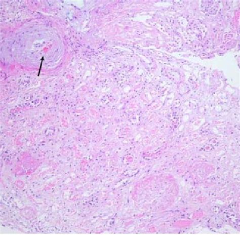 The Mucoid Intimal Hyperplasia Of The Large Sized Artery With Prominent