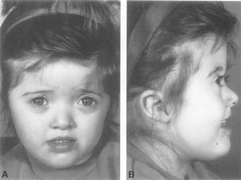 Forgotten Diseases Research Foundation Apert Syndrome Closed
