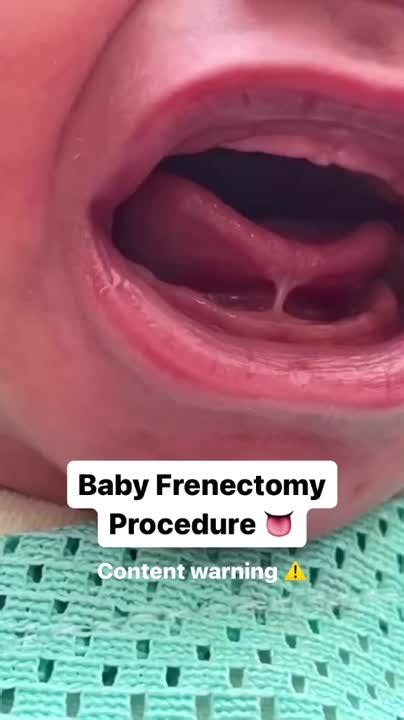 Video Leslie Haller On Linkedin Frenectomy Airway Airwayhealth