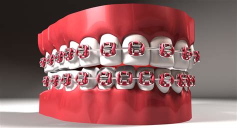 Teeth Braces 3d Model