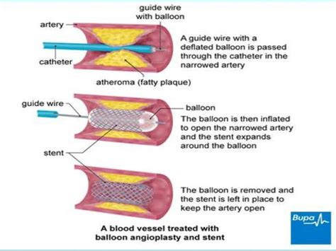 Chronic Peripheral Arterial Occlusive Disease