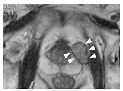 Prostatic Adenocarcinoma With Pseudocapsule Sato World Journal Of Nephrology And Urology