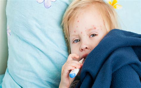 Heres Everything You Need To Know About Chickenpox
