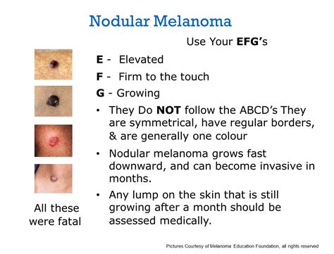 Mission Melanoma Nodular Melanoma
