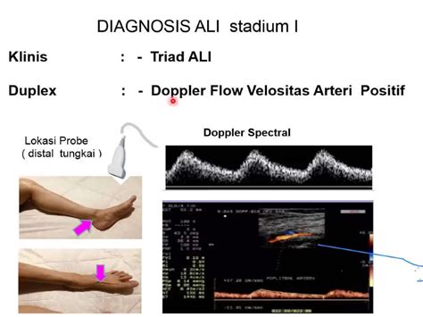 Diagnose And Management Of Acute Limb Ischemia Pptx