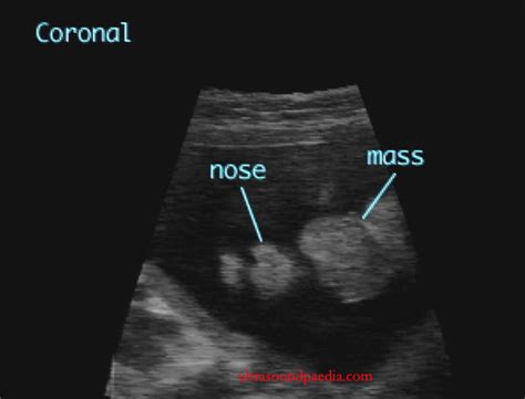 Encephalocele Frontoethmoidal Ultrasoundpaedia
