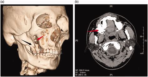 Preoperative Computed Tomography Images A Three Dimensional