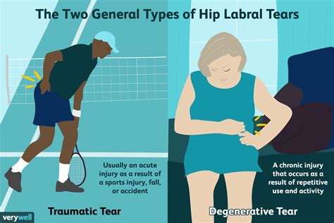 Hip Labral Tear Symptom Management And Treatments